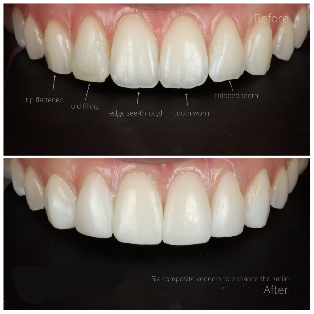 Composite Bonding Silicon Dental