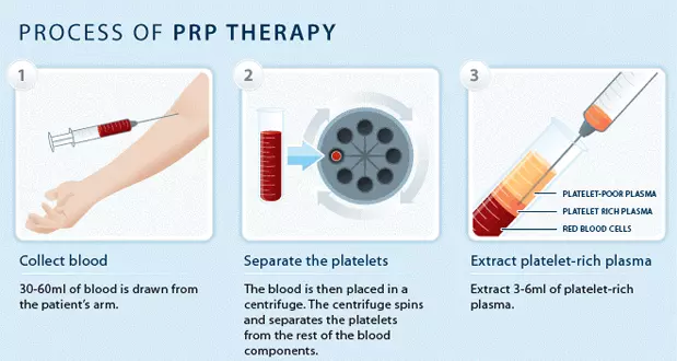 Platelet Rich Plasma - Silicon Dental